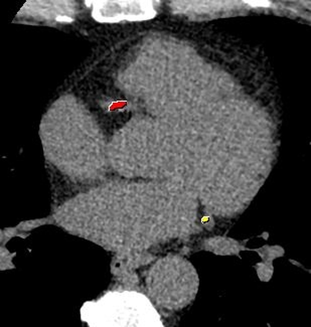 Faire évaluer son score calcique en scanner