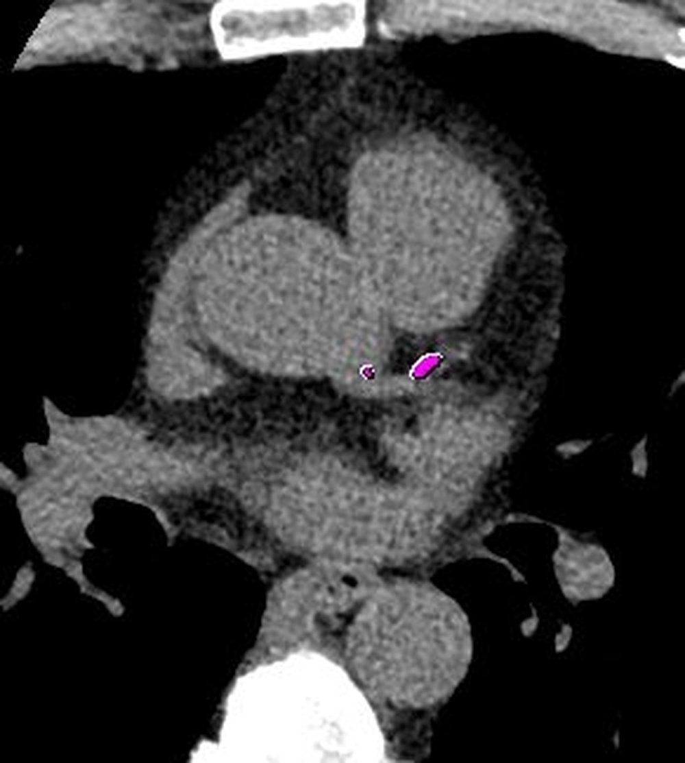 Faire évaluer son score calcique en scanner